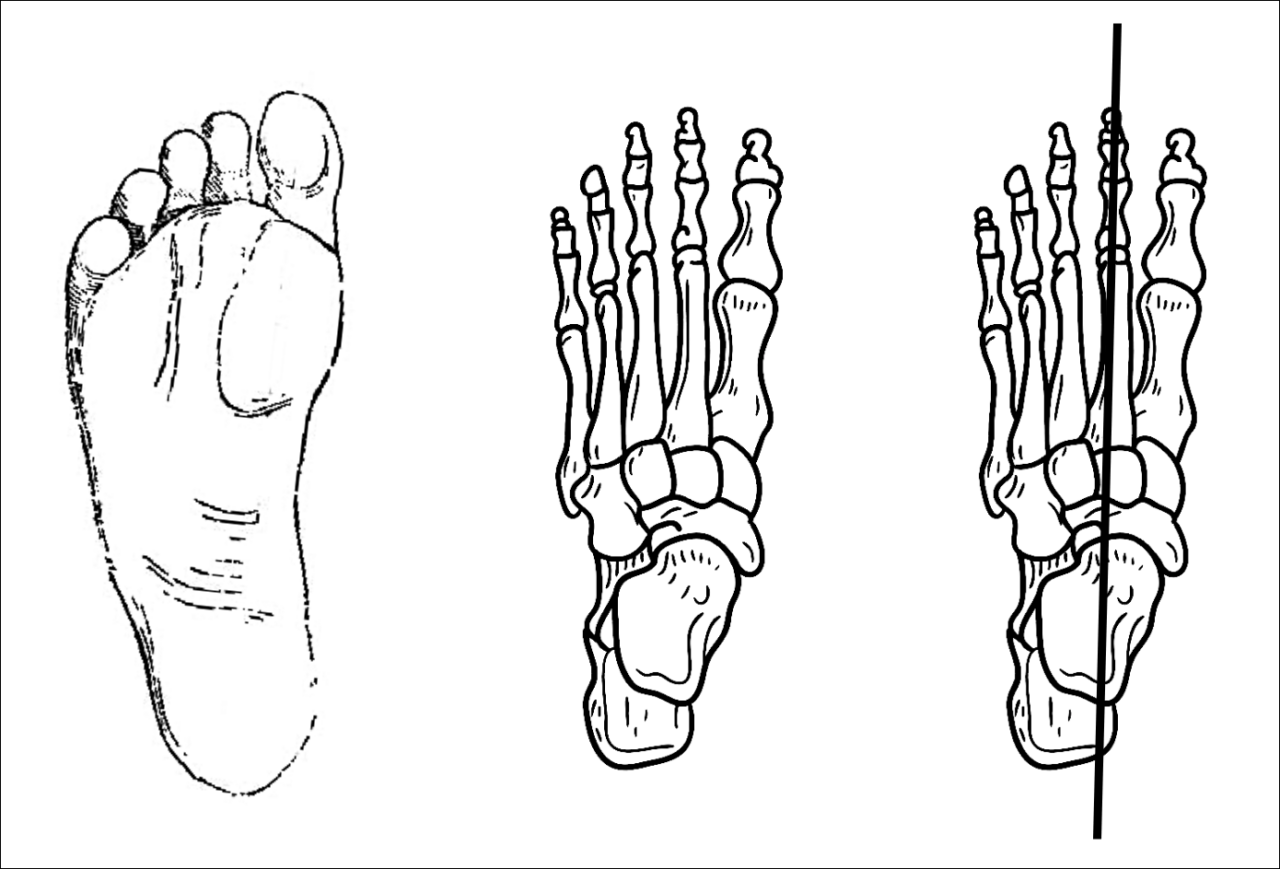 Toe Spacers - MT Performance